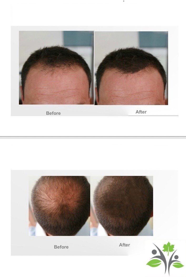 Hair Restoration Treatments: Exploring PRP and Exosome Therapy – NatCan Integrative Medical ...